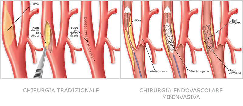Chirurgia della stenosi Carotidea - Cardiochirurgia