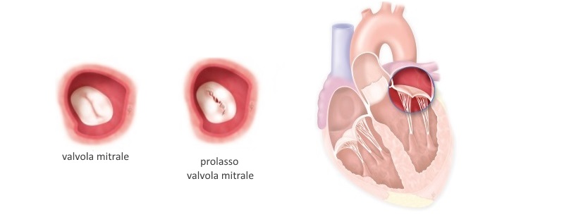 Prolasso mitralico - Cardiochirurgia